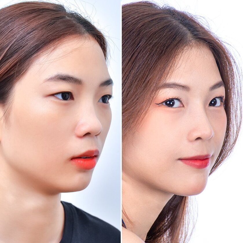 Nâng mũi sụn tai là gì và có an toàn không? - Thẩm mỹ viện